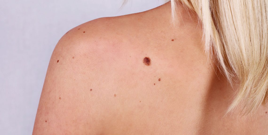 Patch Testing | Q Dermatology